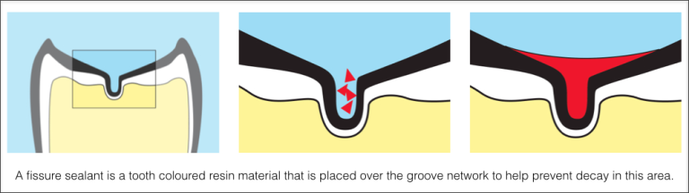Fissure Sealants | Clear Dental Sydney