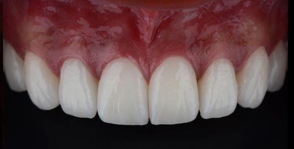 The Power of a Perfect Smile: Understanding Dental Veneers - Clear ...