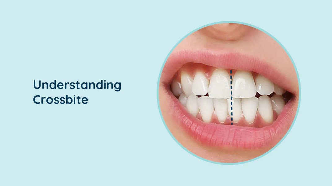 Crossbite Treatment Guide: From Causes to Corrective Options - Clear Dental