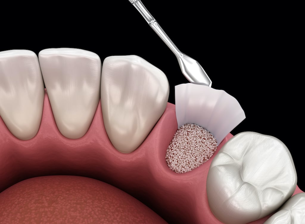Bone Grafting in Dentistry - Clear Dental