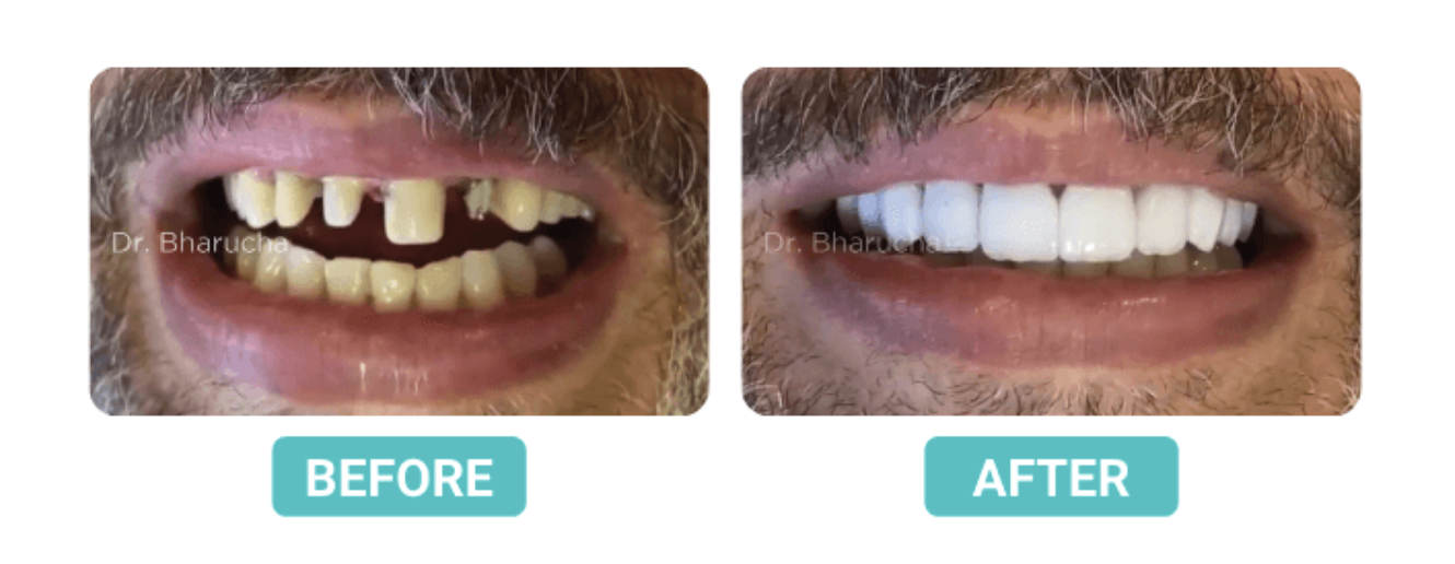 A Fixed Partial Denture - Clear Dental Sydney Dentist