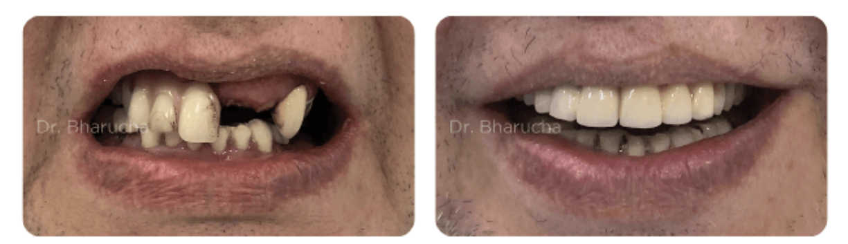 The Veneer Makeover: Restoring Function, Beauty, and Confidence - Clear ...