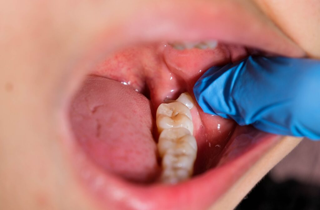 How Wisdom Tooth Removal Helps Your Oral Health - Clear Dental Sydney ...